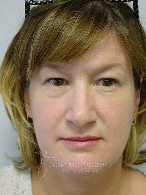 Liposuction patient 3279 - Cosmetic Surgeons of Michigan, P.C.