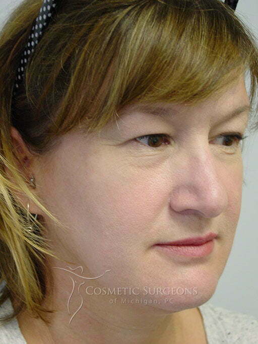 Liposuction patient 3279 - Cosmetic Surgeons of Michigan, P.C.