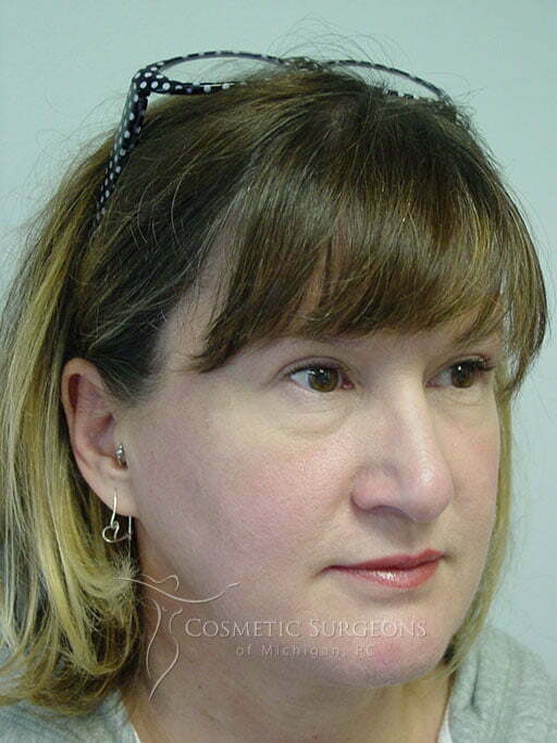 Liposuction patient 3279 - Cosmetic Surgeons of Michigan, P.C.