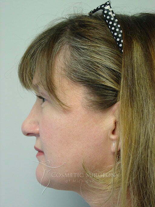 Liposuction patient 3279 - Cosmetic Surgeons of Michigan, P.C.